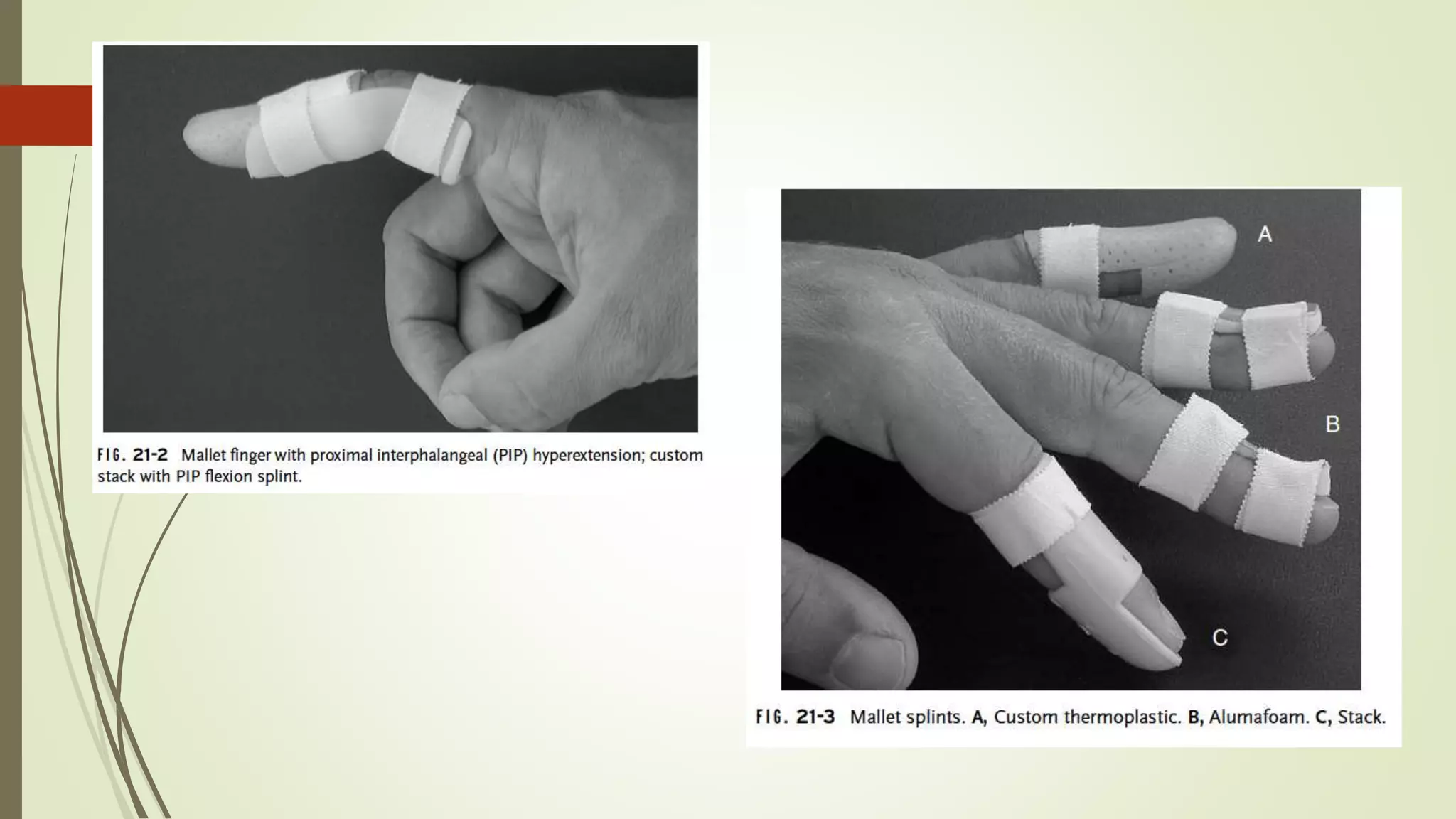 Hand deformities | PPTX