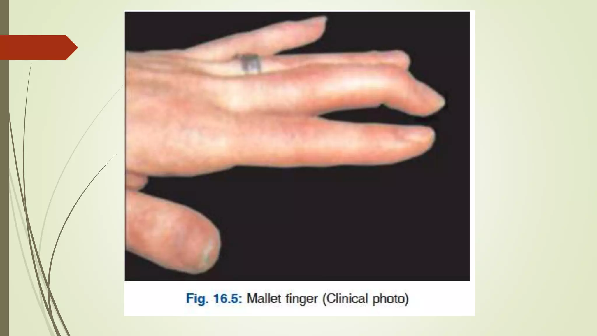 Hand deformities | PPTX