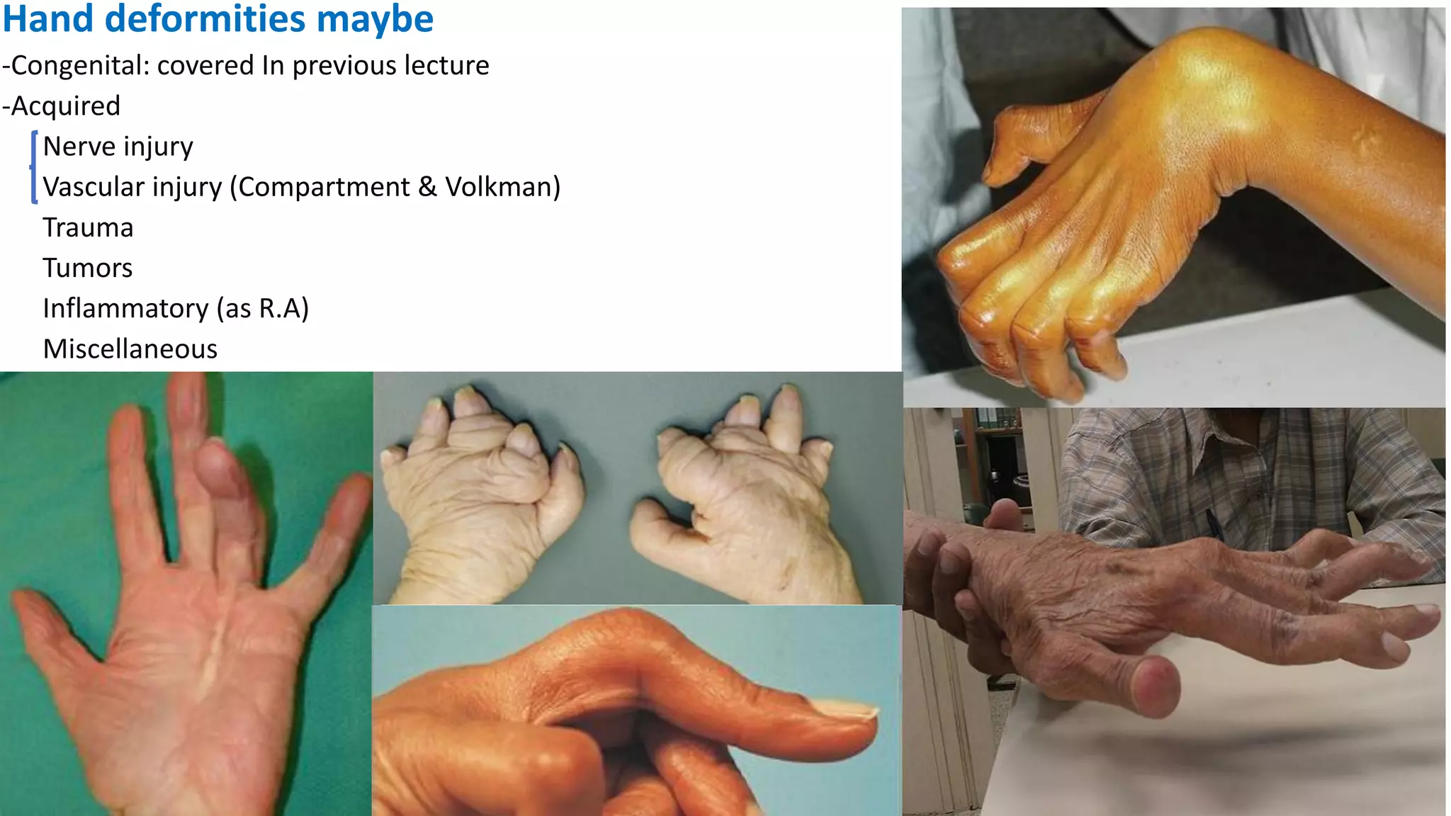 Hand deformities upload | PDF
