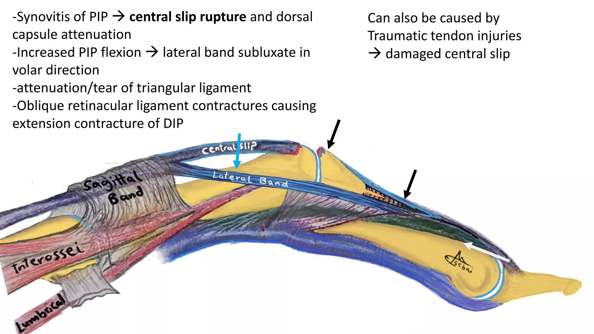 Hand deformities upload | PPT