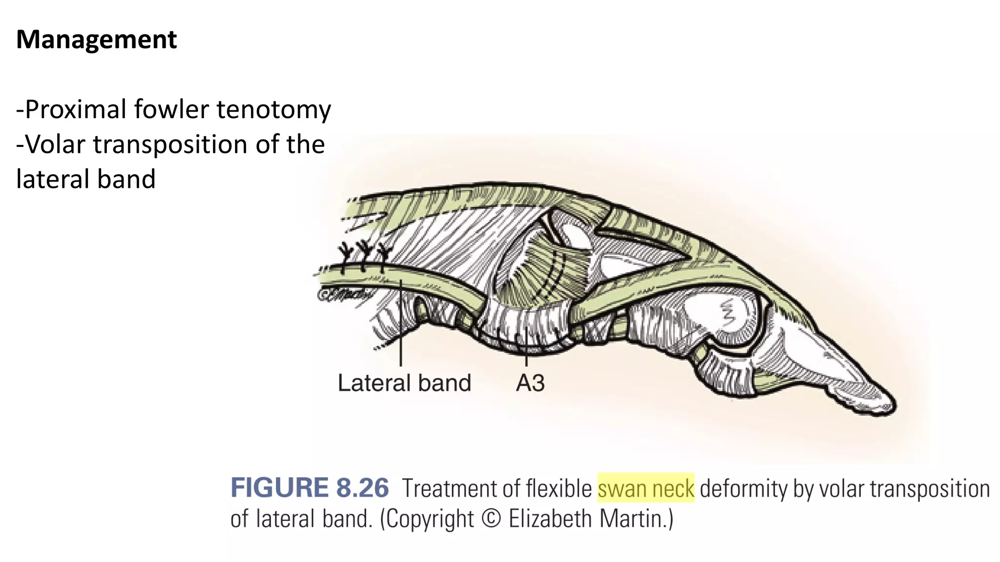 Hand deformities upload | PDF