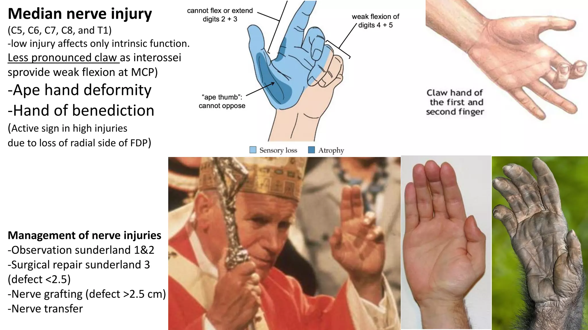 Hand deformities upload | PDF