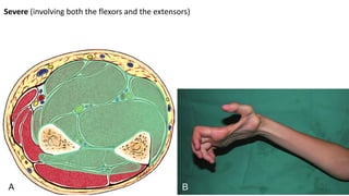 Hand deformities upload | PDF
