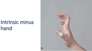 Hand deformities upload | PDF