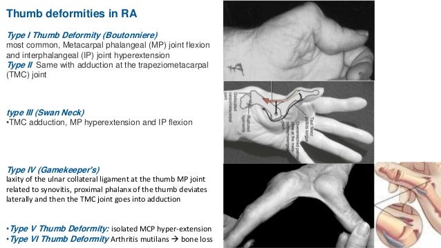 Hand deformities upload