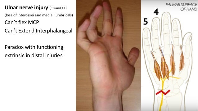 Hand deformities upload