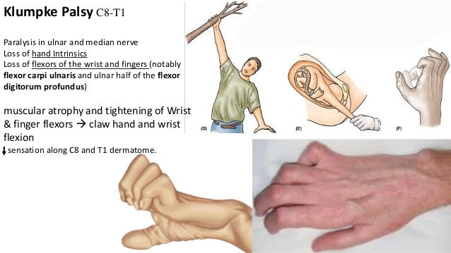 Hand deformities upload