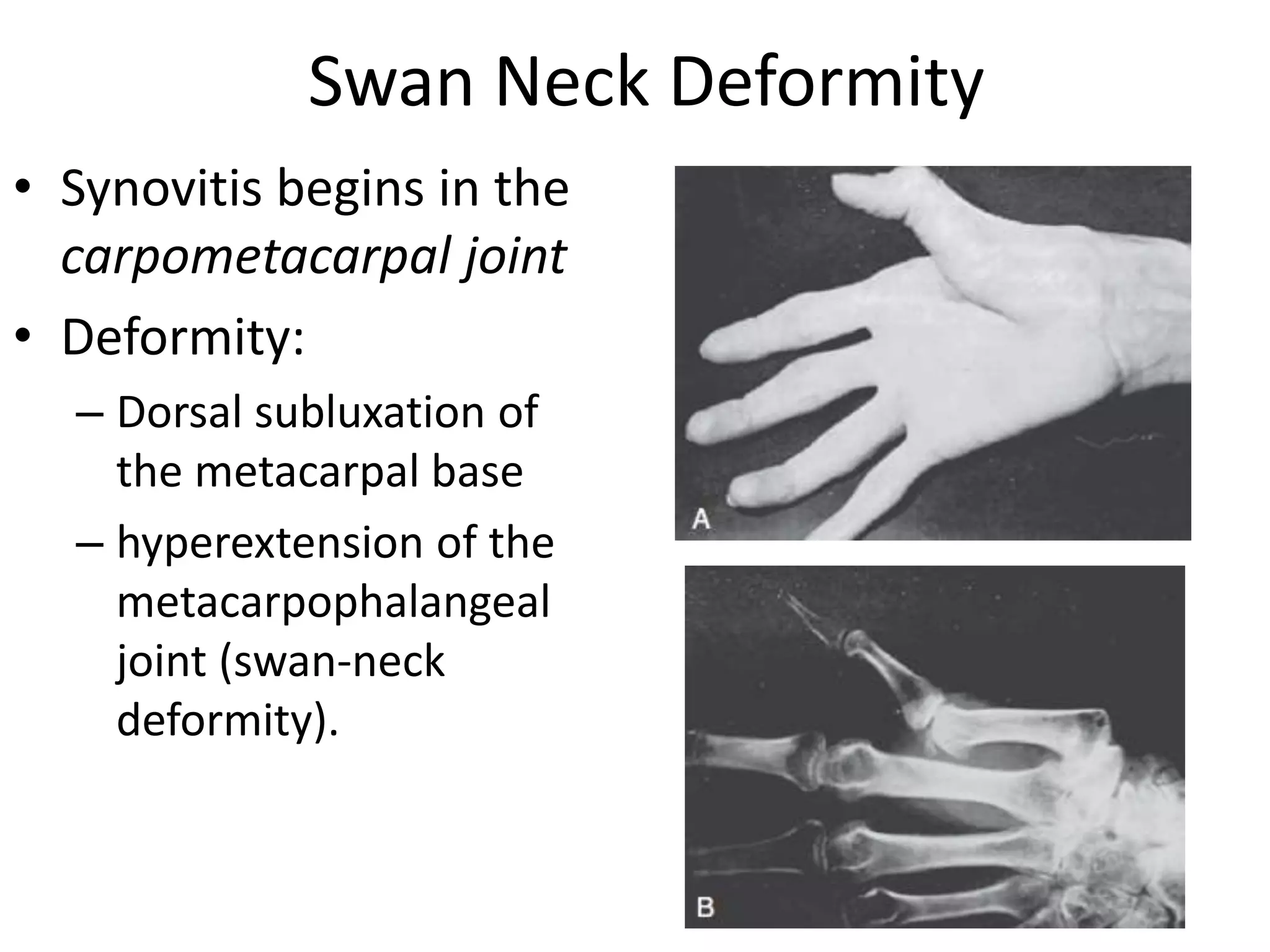 Hand deformity in rheumatoid arthritis | PPTX