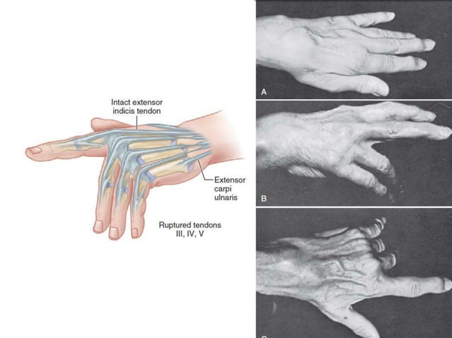 Hand deformity in rheumatoid arthritis | PPTX | Death, Injury, or ...