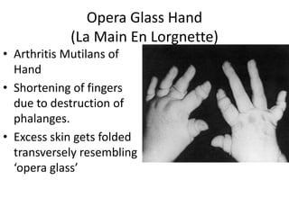 Hand deformity in rheumatoid arthritis | PPT