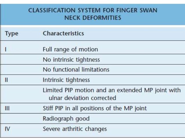 Hand deformity in rheumatoid arthritis