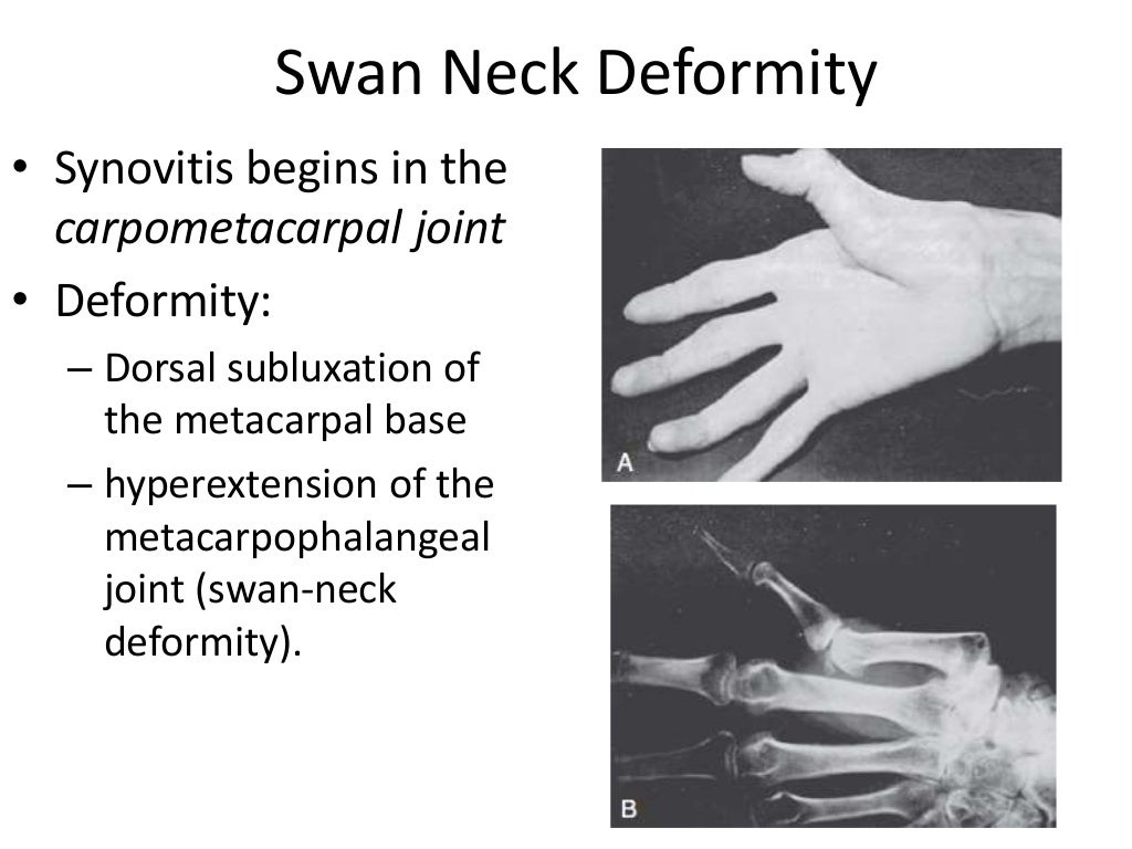 Hand deformity in rheumatoid arthritis