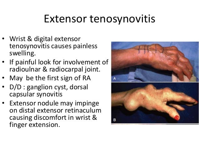 Hand deformity in rheumatoid arthritis