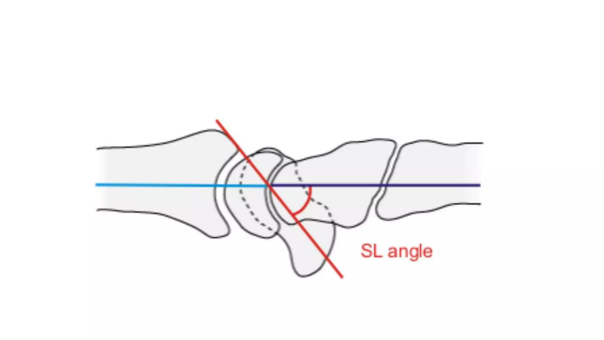 Hand fractures | PPTX