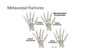 Hand fractures | PPTX
