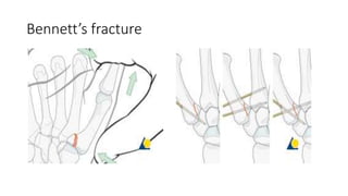 Hand fractures | PPTX