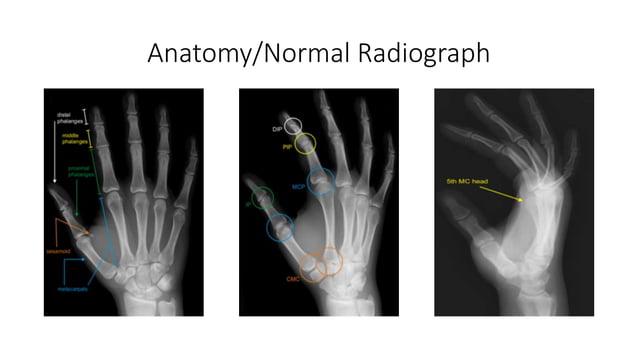 Hand fractures | PPT