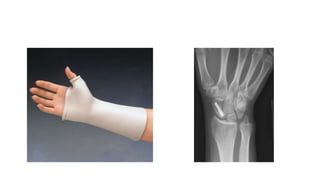 Hand fractures | PPTX