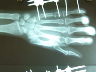 HAND FRACTURES PHALANX METACARPALS.pptx