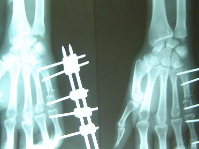 HAND FRACTURES PHALANX METACARPALS.pptx
