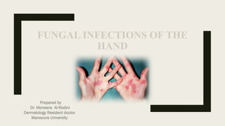Hand fungal infection . | PPTX