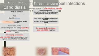 Hand fungal infection . | PPT