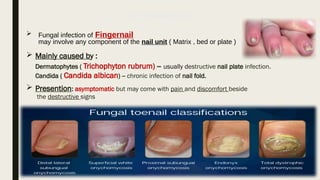 Hand fungal infection . | PPT