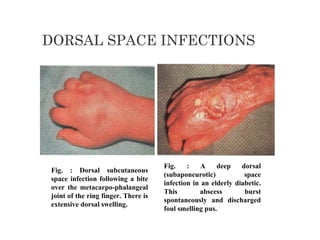 Hand infections | PPT