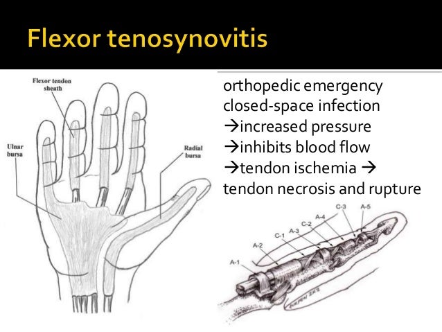 Horseshoe Abscess Hand Infections Of The Hand And Wrist: Anatomical