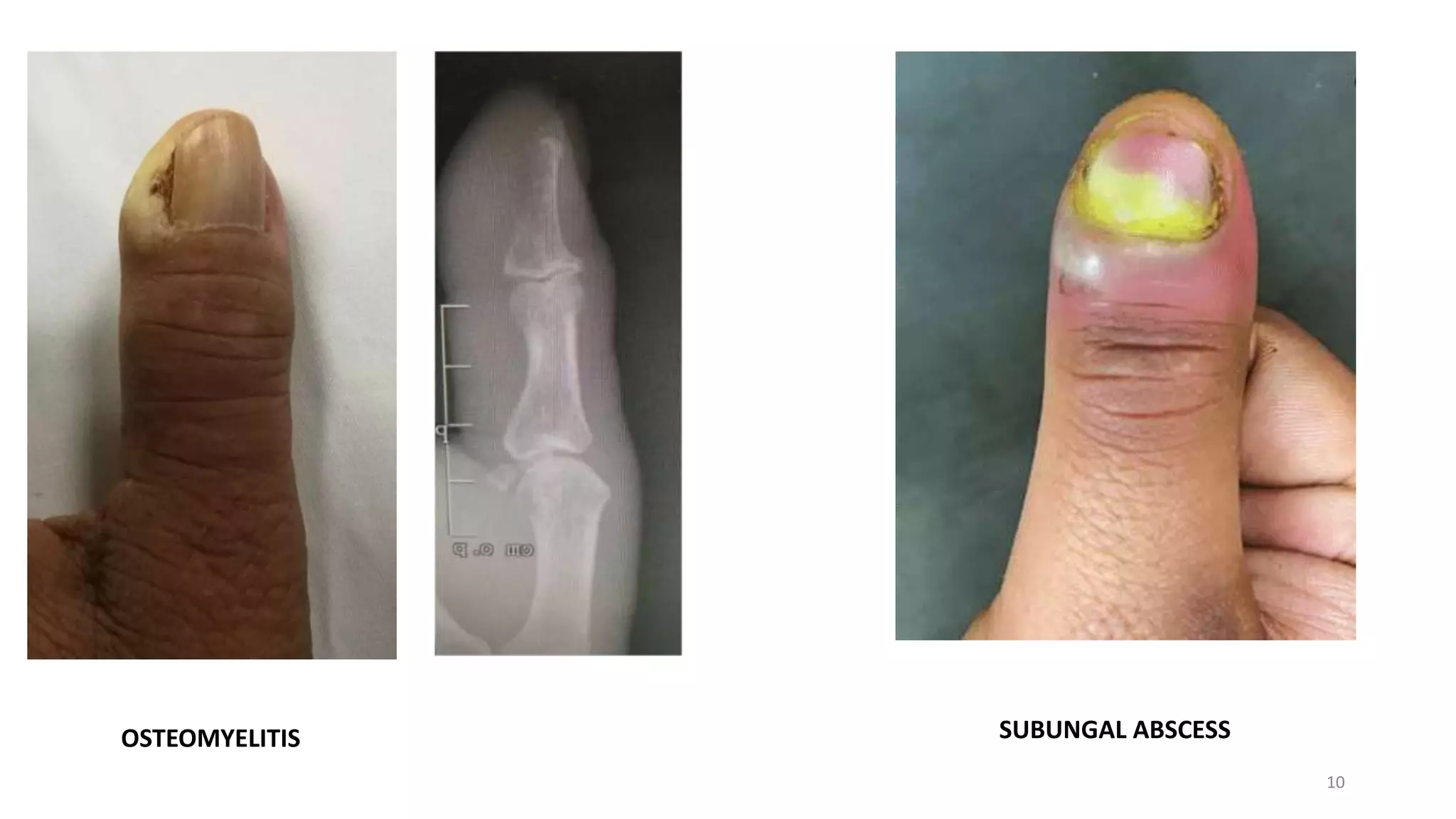 Hand Infection .pptx