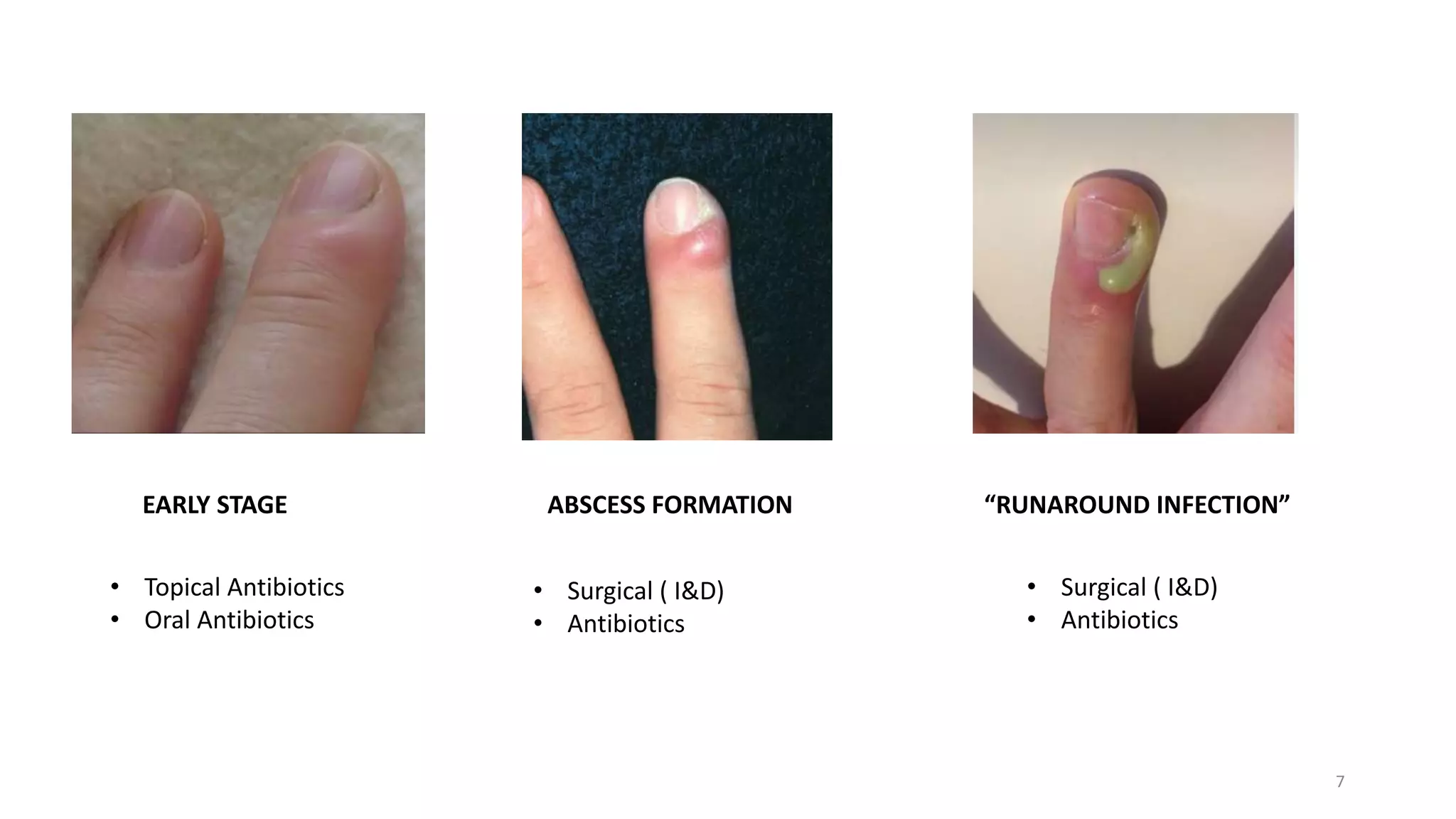 Hand Infection .pptx