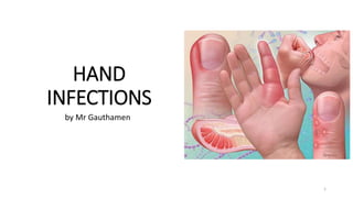 Hand Infection .pptx | Nail Care | Beauty
