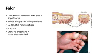 Hand Infection .pptx