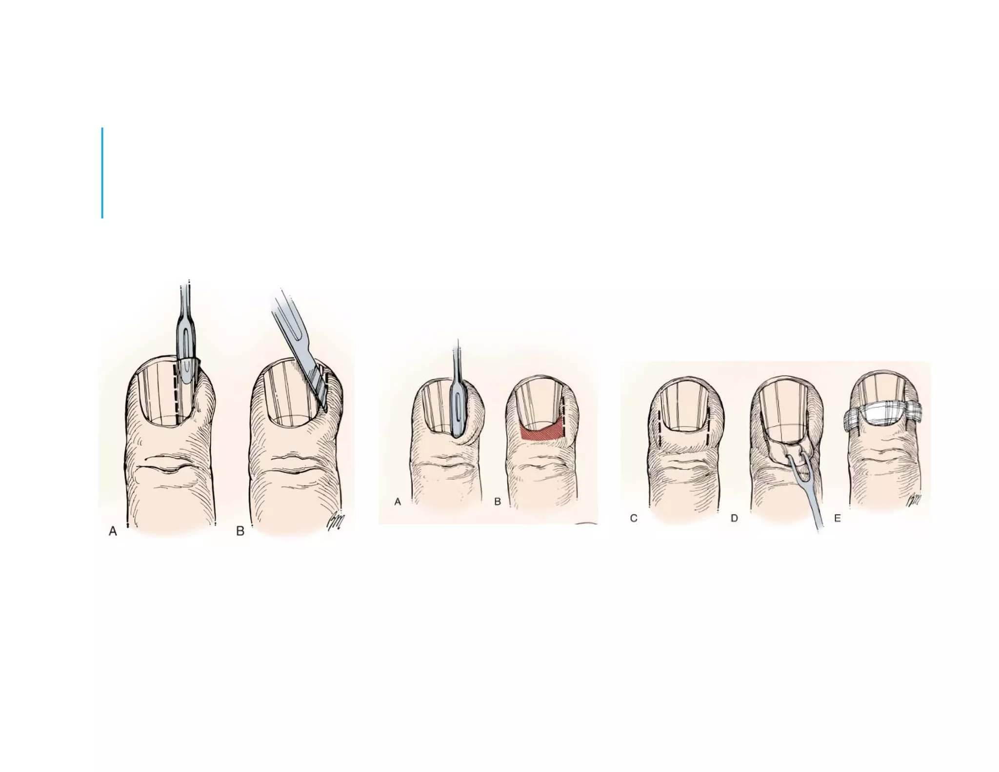 Hand infection - An often ignored problem | PDF
