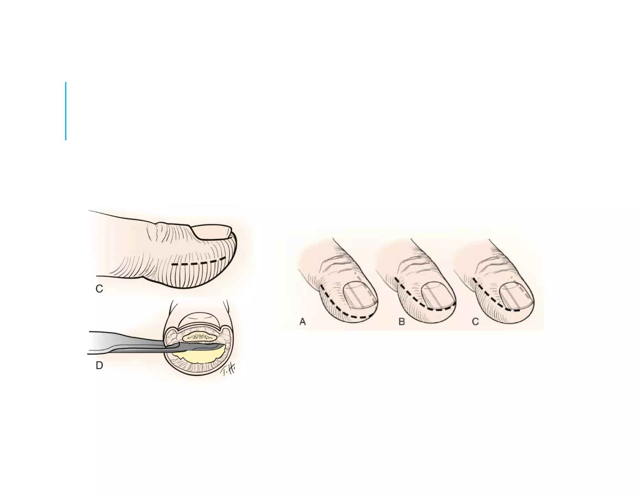 Hand infection - An often ignored problem | PDF