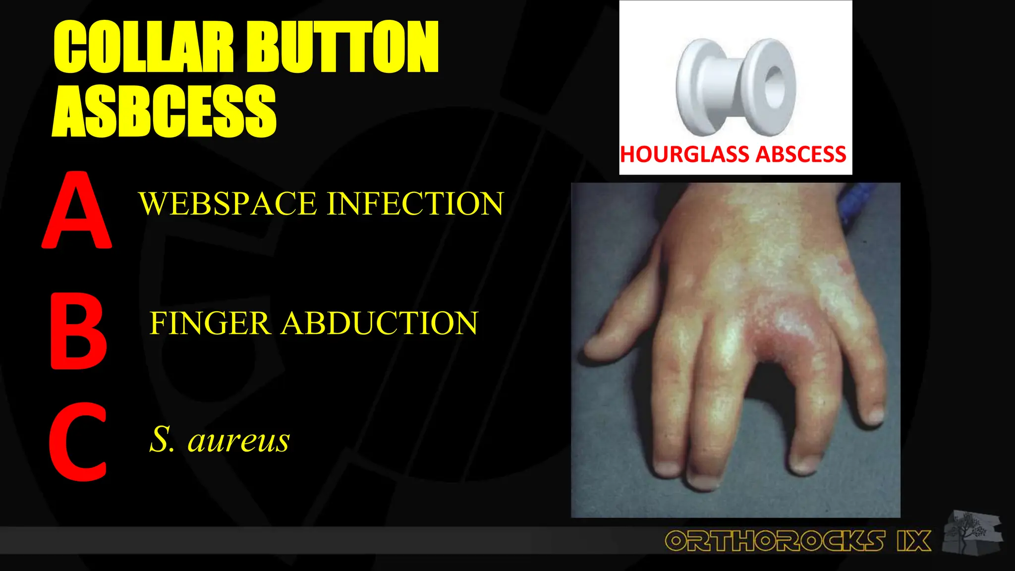 COMMON HAND INFECTION ORTHO SURGERY.pptx