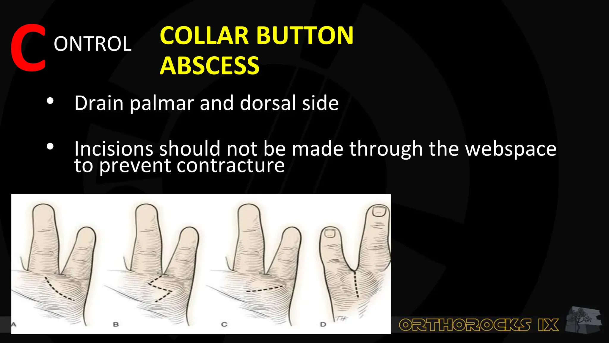 COMMON HAND INFECTION ORTHO SURGERY.pptx