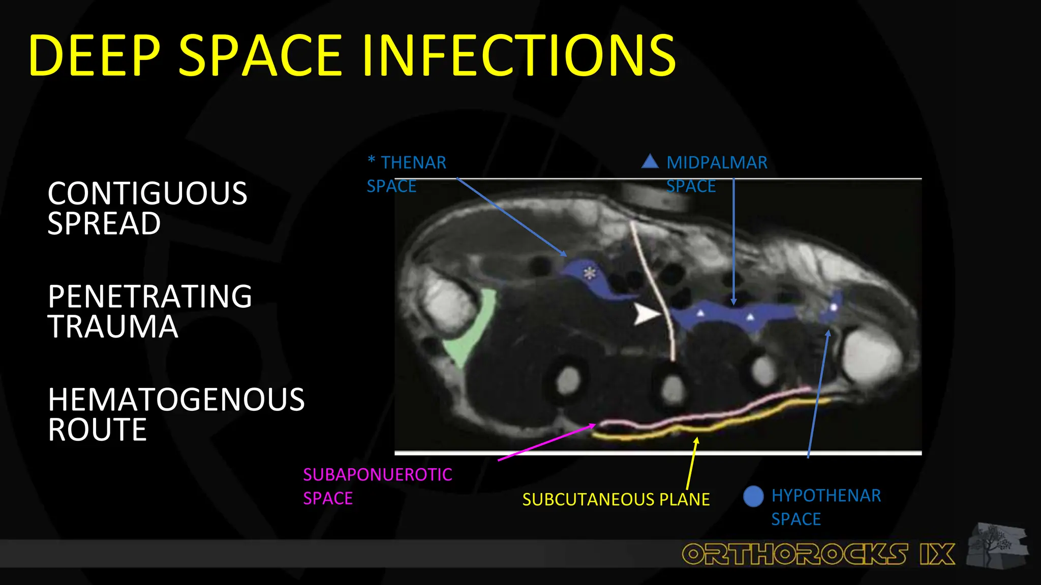 COMMON HAND INFECTION ORTHO SURGERY.pptx