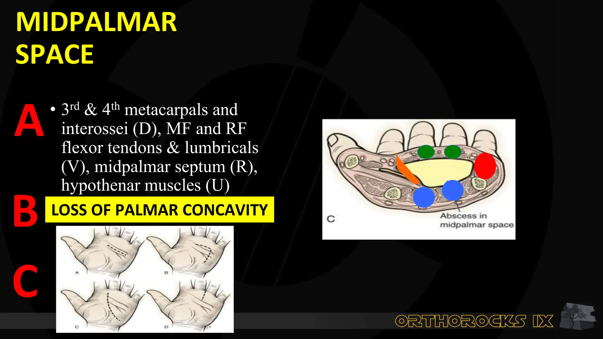 COMMON HAND INFECTION ORTHO SURGERY.pptx