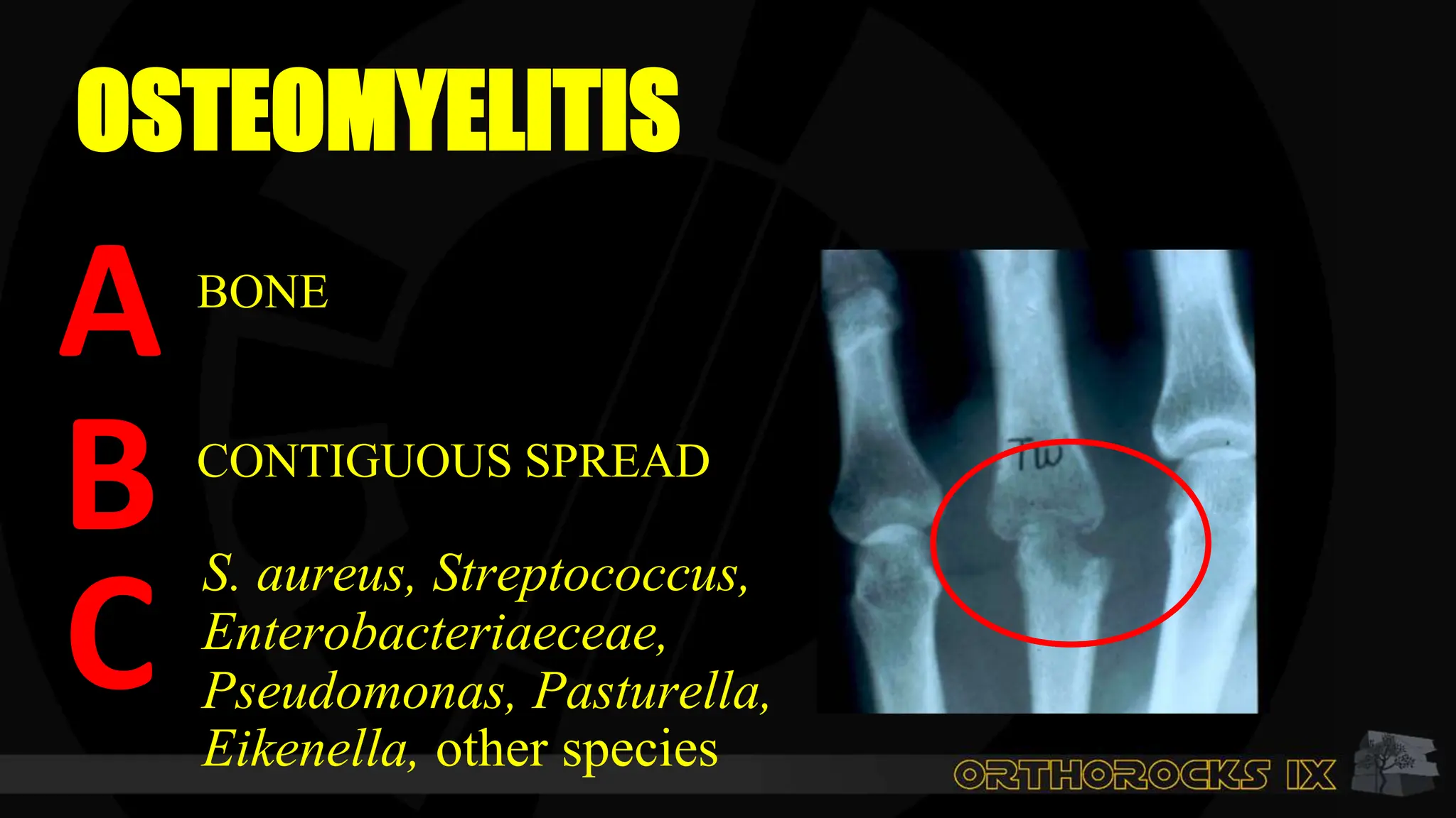 COMMON HAND INFECTION ORTHO SURGERY.pptx
