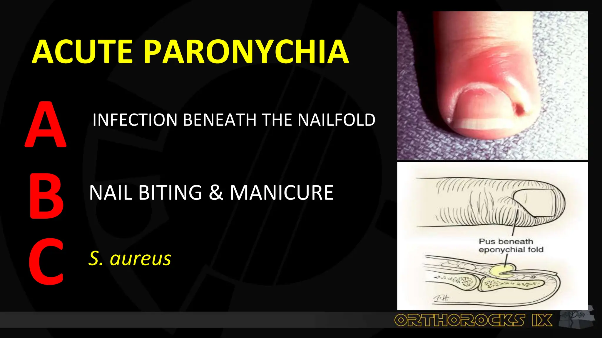 COMMON HAND INFECTION ORTHO SURGERY.pptx