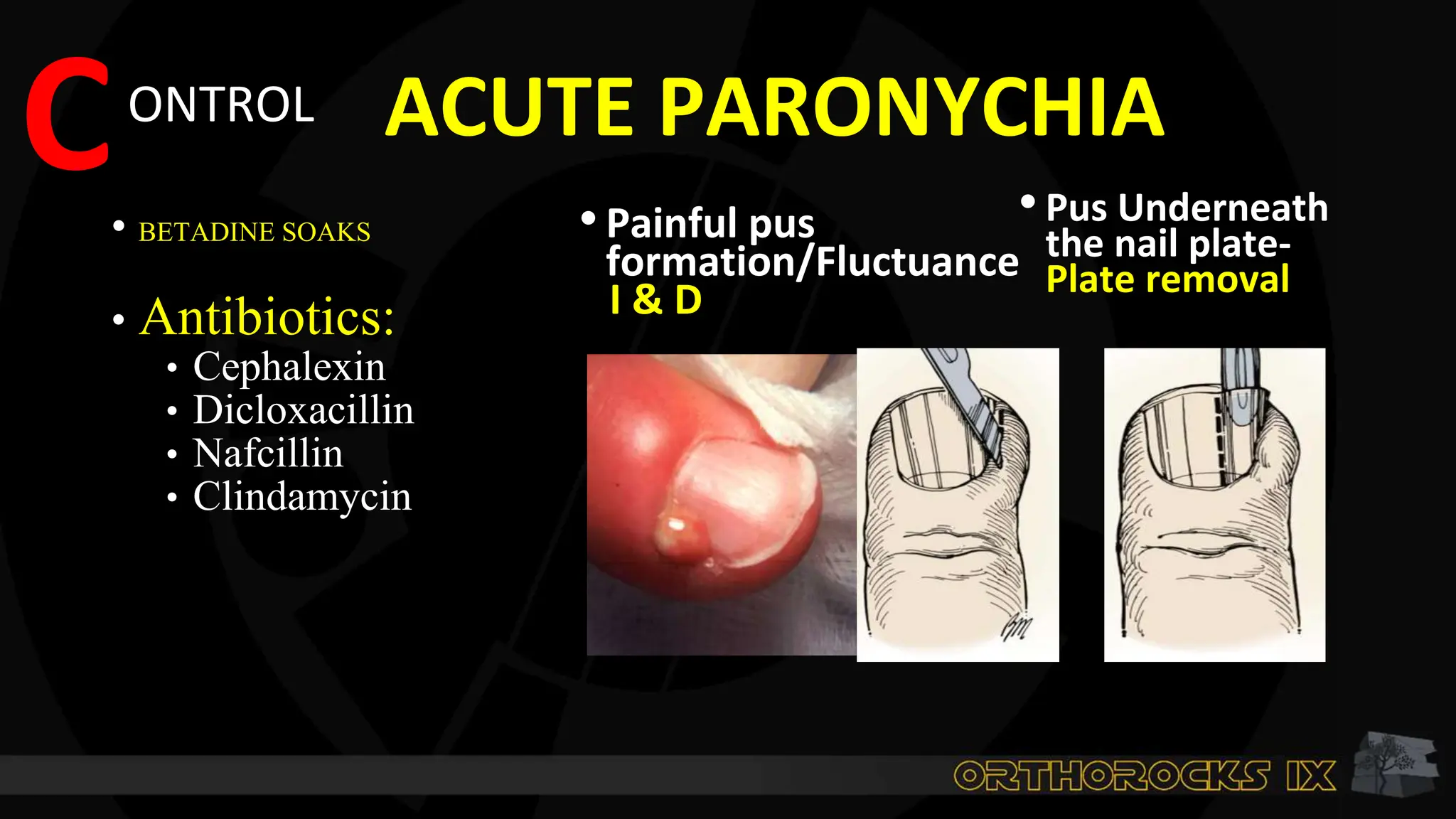 COMMON HAND INFECTION ORTHO SURGERY.pptx