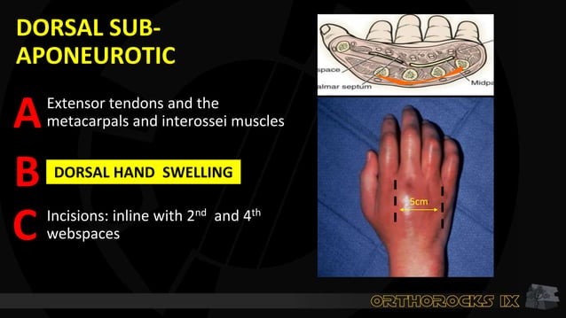 COMMON HAND INFECTION ORTHO SURGERY.pptx