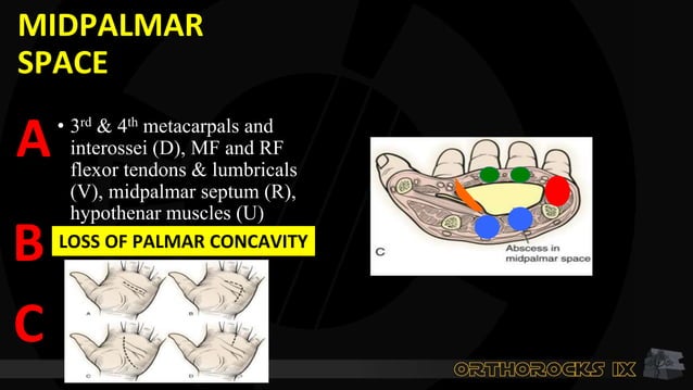 COMMON HAND INFECTION ORTHO SURGERY.pptx