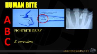 COMMON HAND INFECTION ORTHO SURGERY.pptx
