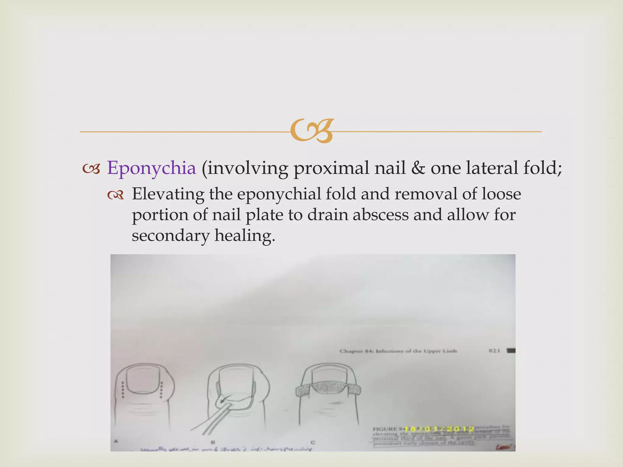 Hand infections | PPTX