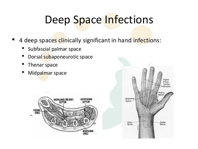 Hand infections