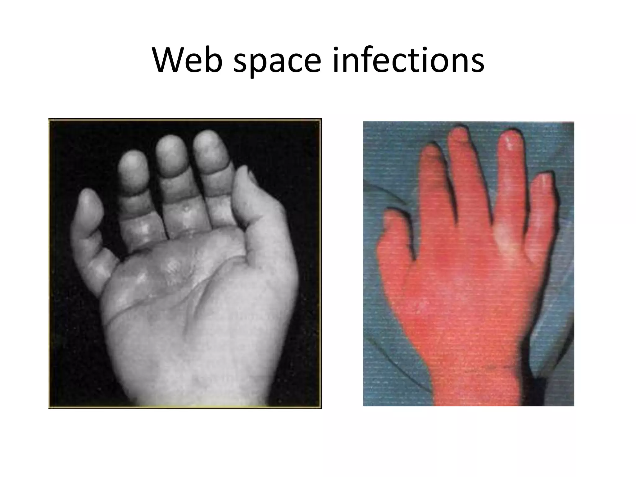 Hand Infections | PPTX