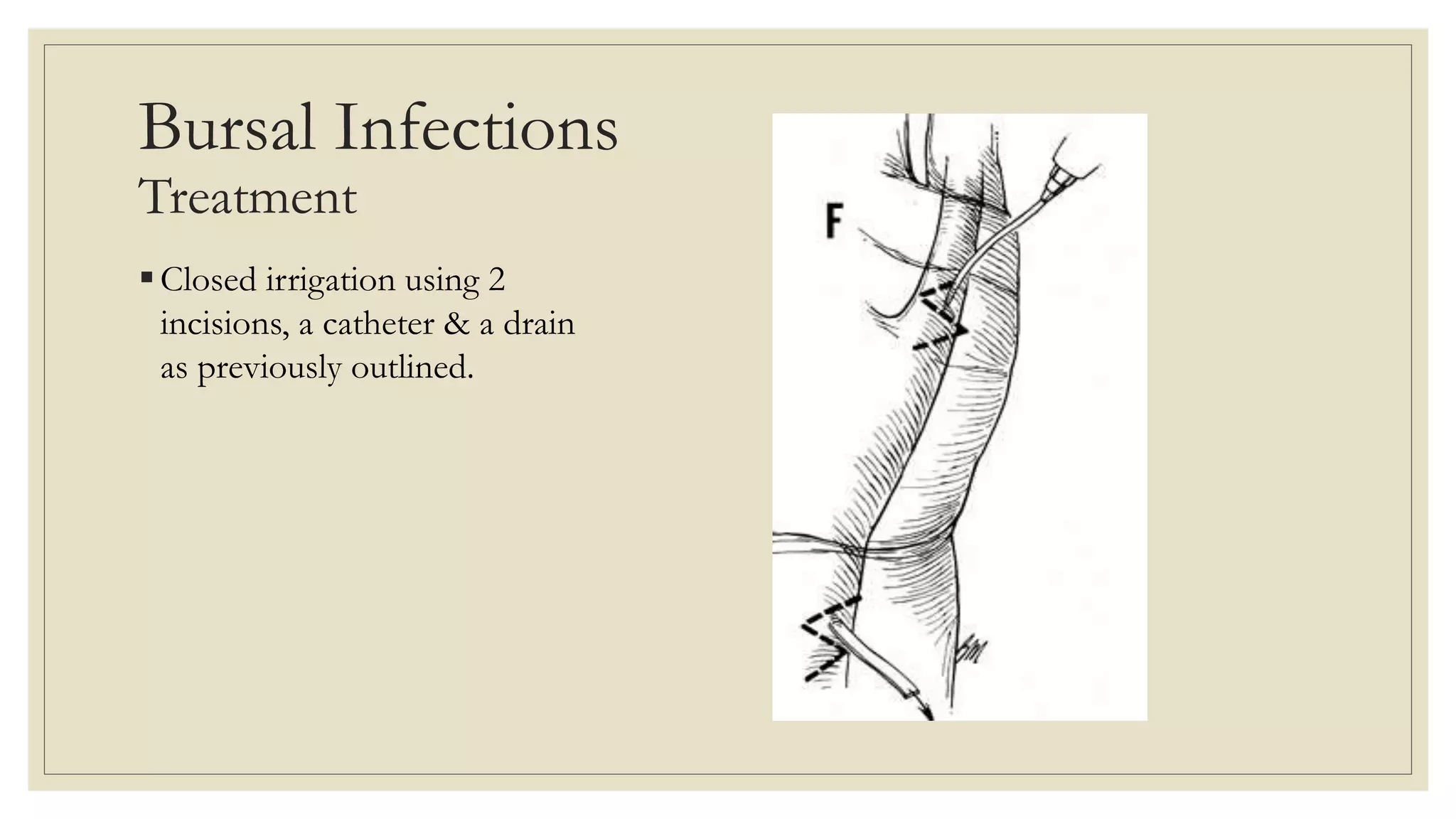 Hand infections | PPTX