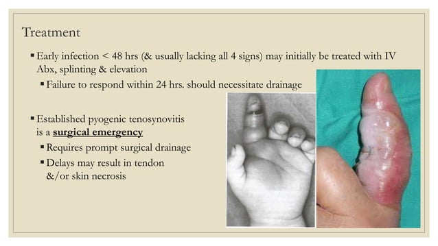 Hand infections | PPTX